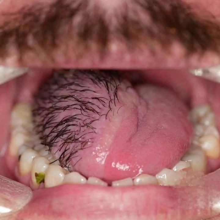 When Skin Grafts Grow Hair on the Tongue: An Unusual Side Effect of ...